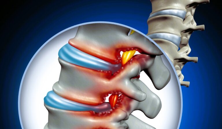"Lumbar Stenosis: Understanding Its Signs, Symptoms, Causes,